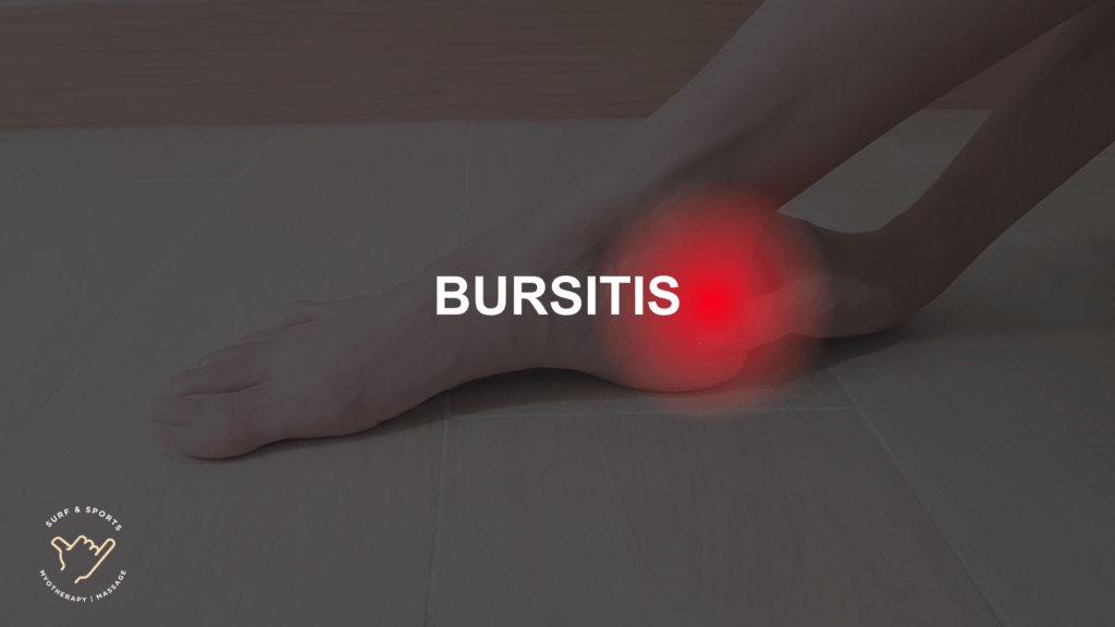 Pain Relief, Symptoms and Causes for Bursitis - Surf and Sports Myotherapy